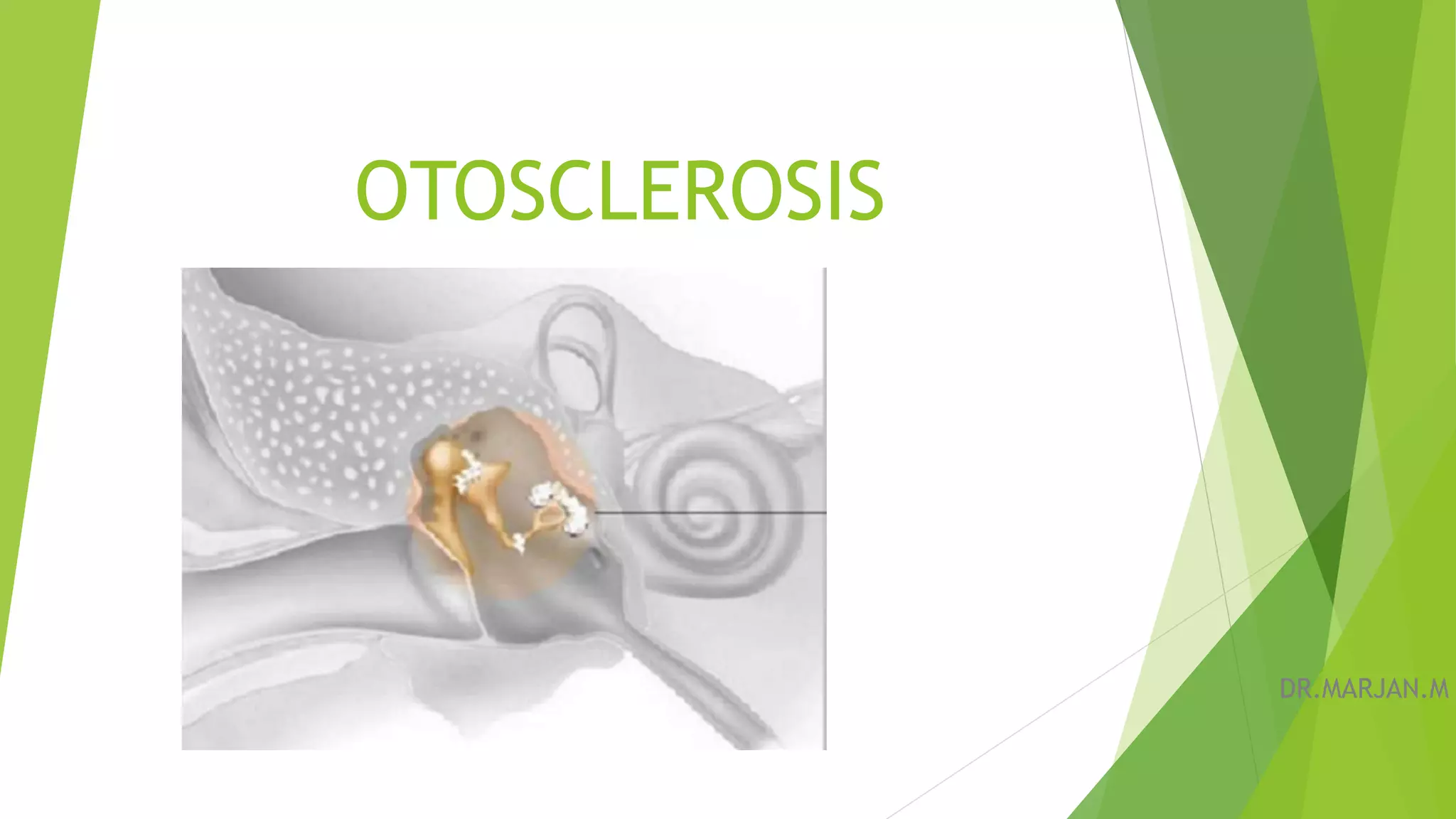 Otosclerosis | PPTX | Ear, Nose and Throat Conditions | Diseases and ...
