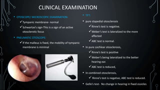 Otosclerosis Otoscopy