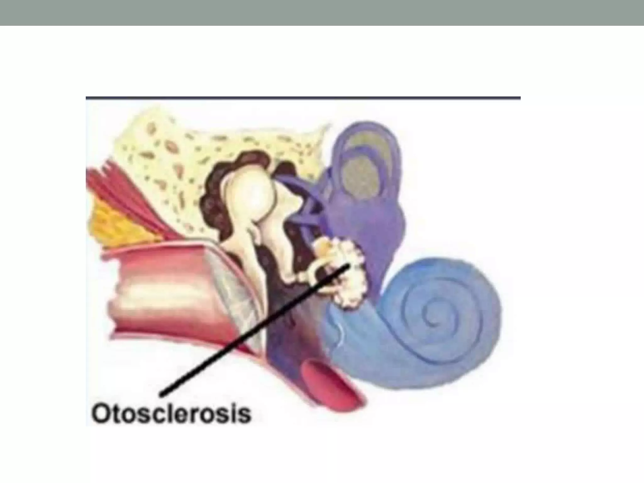 Otosclerosis | PPTX