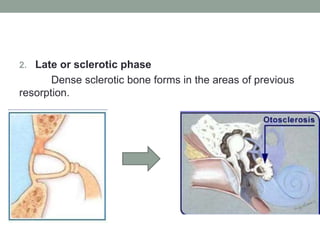 Otosclerosis | PPTX