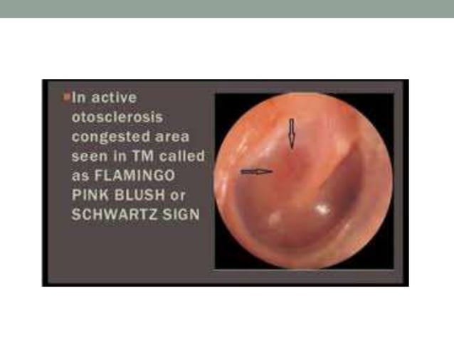Otosclerosis | PPTX | Ear, Nose and Throat Conditions | Diseases and ...