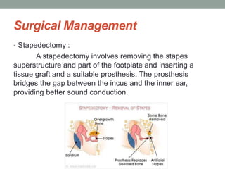otosclerosis-200825060058 (1).pptx