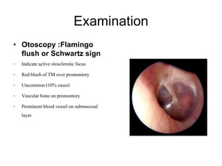 Otosclerosis Otoscopy