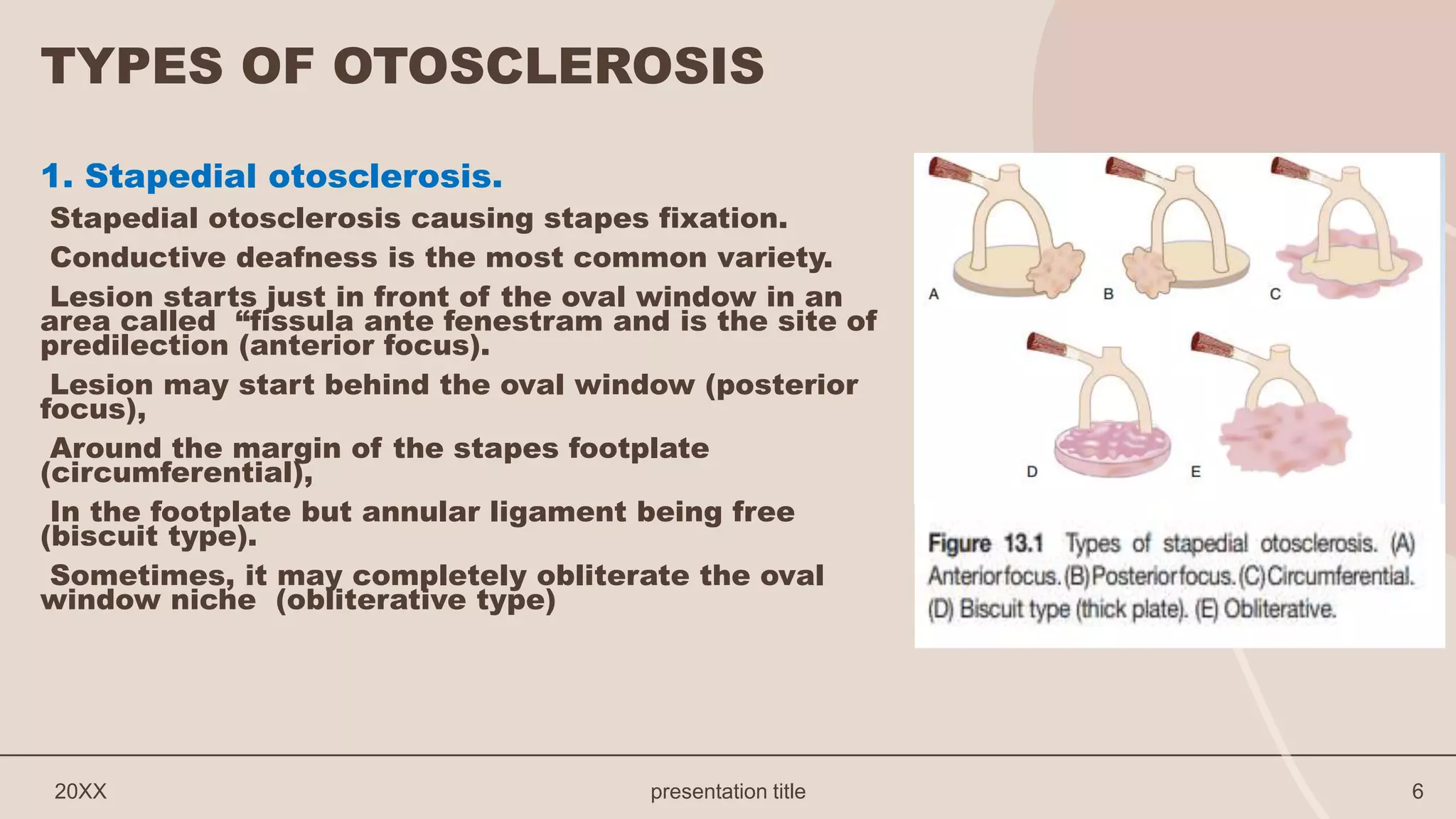 OTOSCLEROSIS | PPT