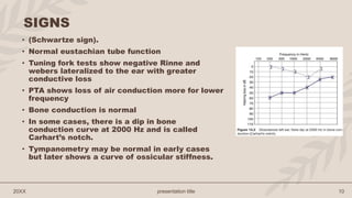 OTOSCLEROSIS | PPTX