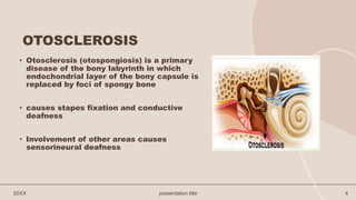OTOSCLEROSIS | PPTX