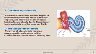 OTOSCLEROSIS | PPTX