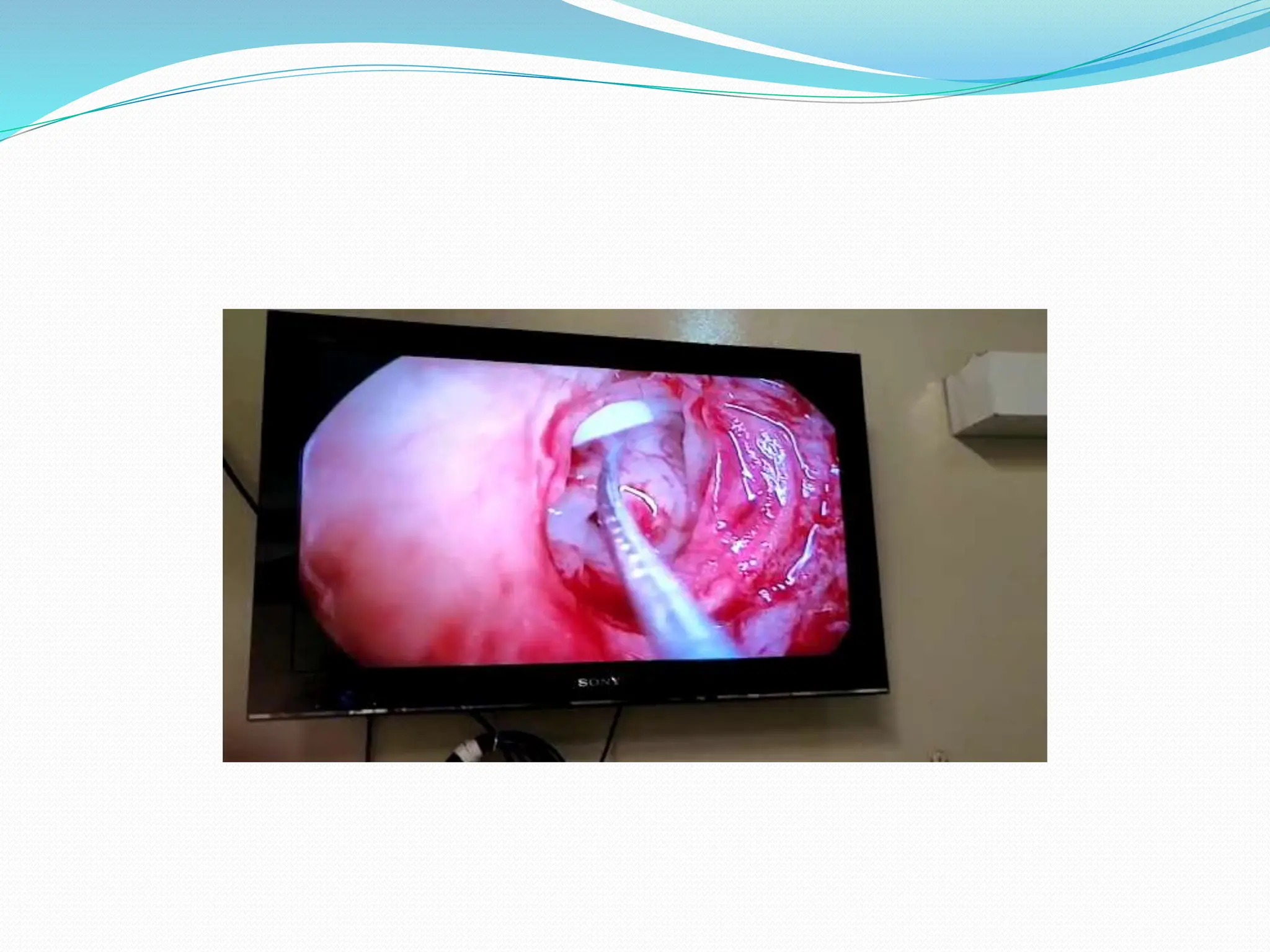 otosclerosis.pptx | Ear, Nose and Throat Conditions | Diseases and ...