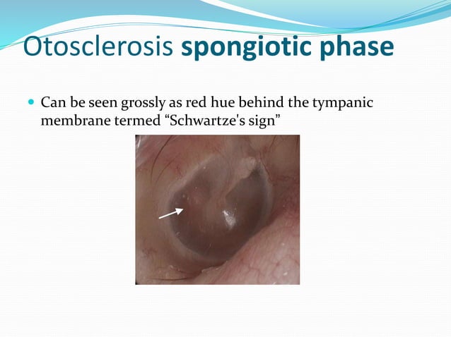 otosclerosis.pptx | Ear, Nose and Throat Conditions | Diseases and ...