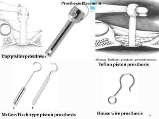 otosclerosis.pptx | Ear, Nose and Throat Conditions | Diseases and ...