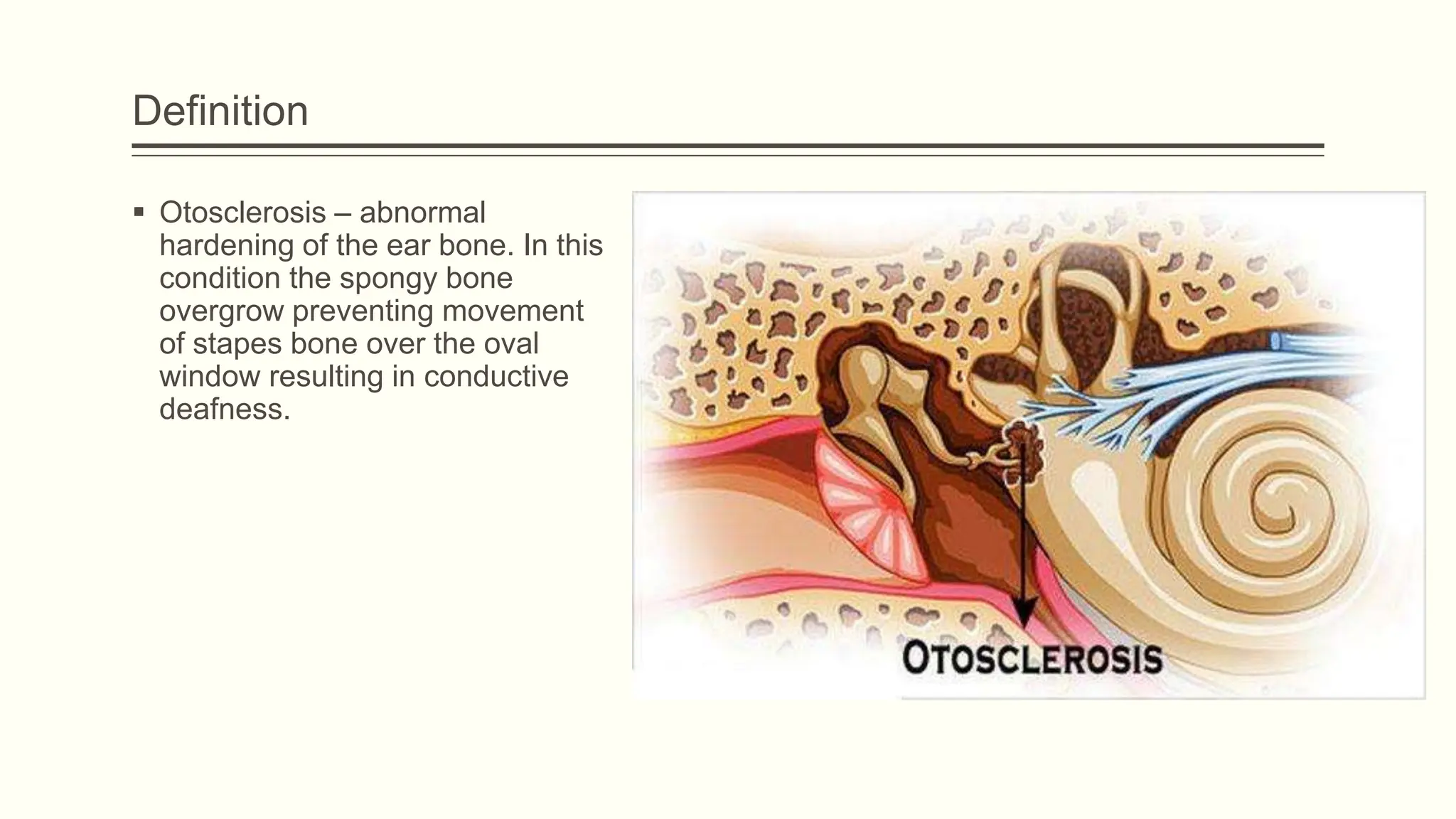 OTOSCLEROSIS - causes, types, symptoms & treatment | PPTX