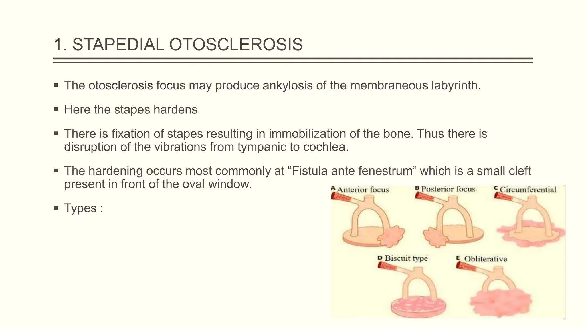 OTOSCLEROSIS - causes, types, symptoms & treatment | PPTX
