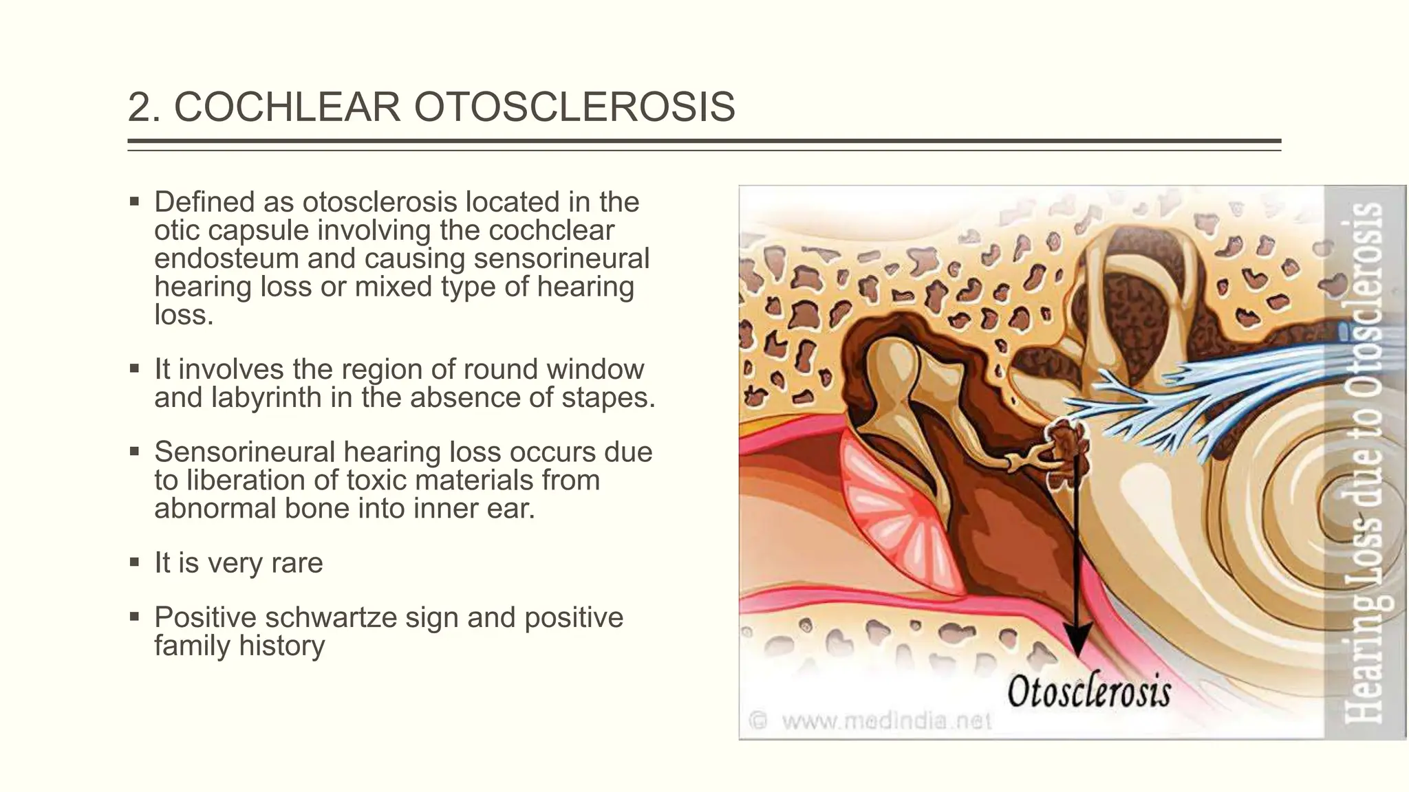 OTOSCLEROSIS - causes, types, symptoms & treatment | PPTX