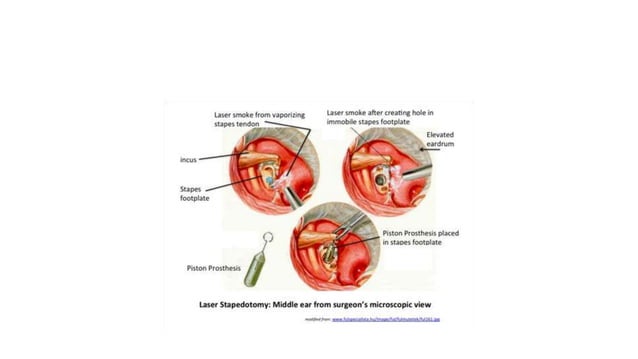 OTOSCLEROSIS in ear nose and throat .pptx