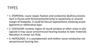 OTOSCLEROSIS in ear nose and throat .pptx
