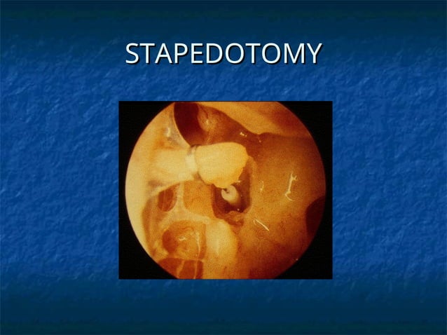 Otosclerosis -Disease of Ear- Otorhionolaryngology | PPT