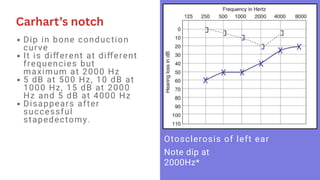 Otosclerosis.pdf 2 Otosclerosis tympanic | PDF