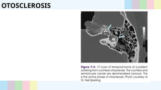 otosclerosis- history, pathology, stapedectomy | PPTX