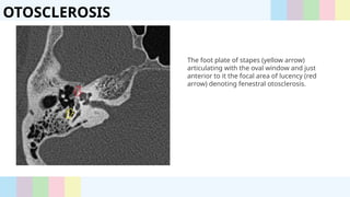otosclerosis- history, pathology, stapedectomy | PPTX