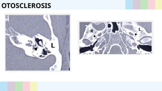 otosclerosis- history, pathology, stapedectomy | PPTX