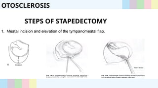 otosclerosis- history, pathology, stapedectomy | PPTX