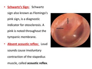 Otosclerosis Tympanic Membrane