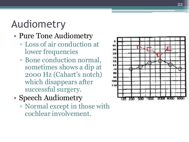 Otosclerosis ENT