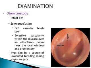 otosclerosis | PPT