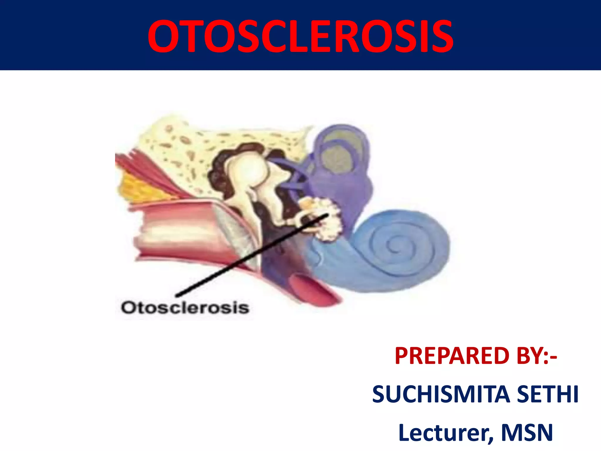 Otosclerosis (2) | PPTX