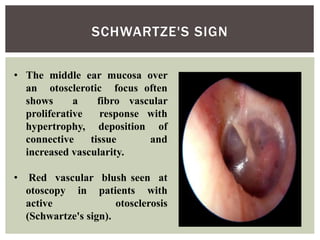 Otosclerosis | PPT