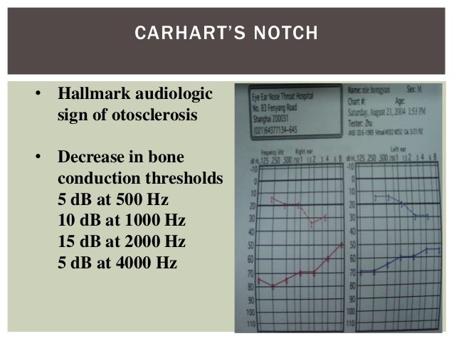 Otosclerosis