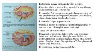 Otosclerosis and its management.pdf