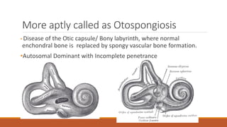 Otosclerosis - Arjun Antony Graison | PPT