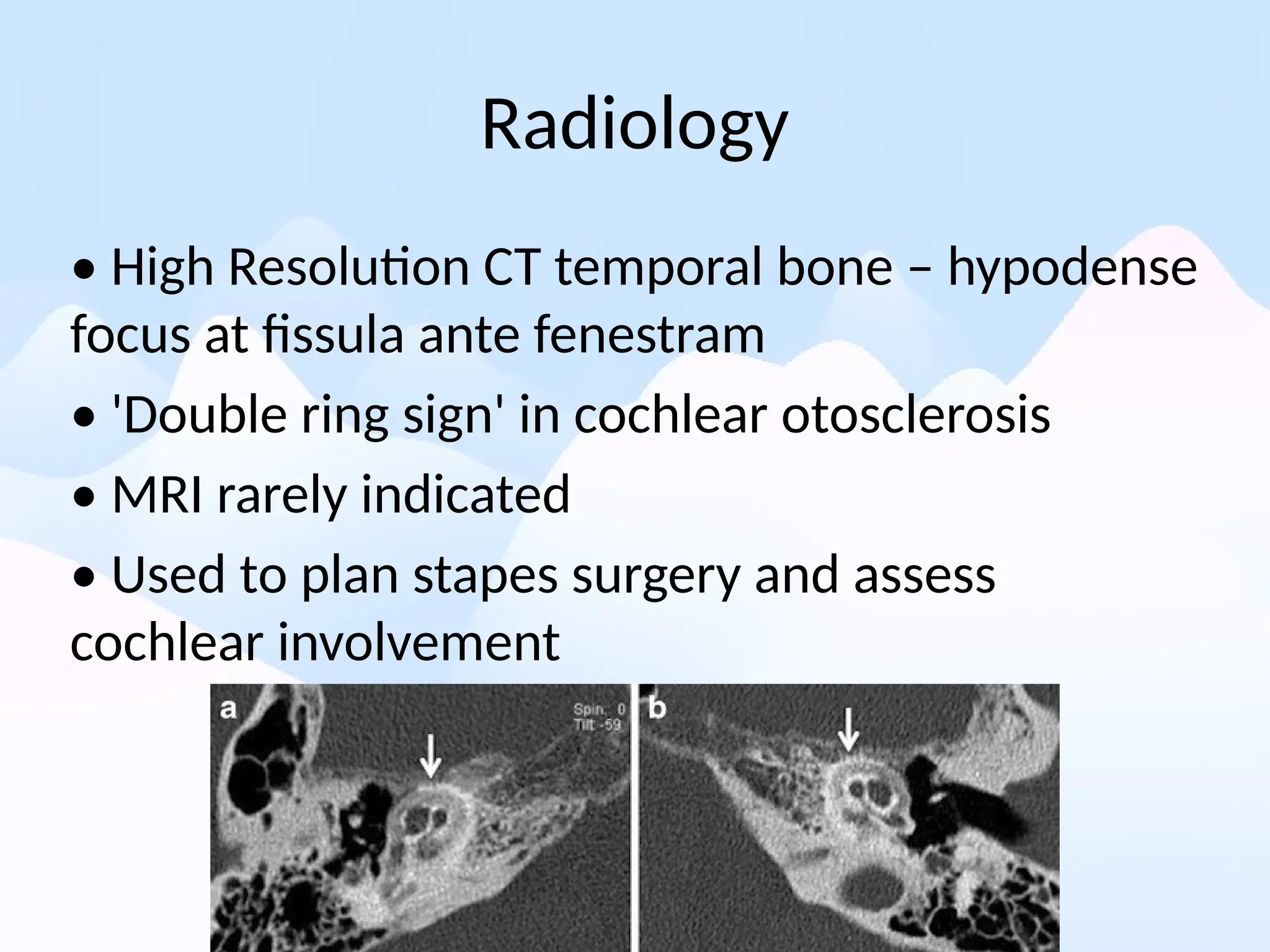 Otosclerosis_Detailed_Dhingra_Presentation.pptx