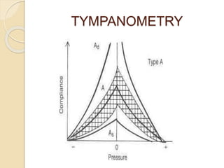 Otosclerosis Tympanogram