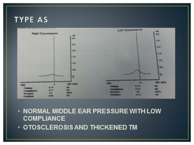 otosclerosis kalpana.pptx ent ear ppt . | PPT