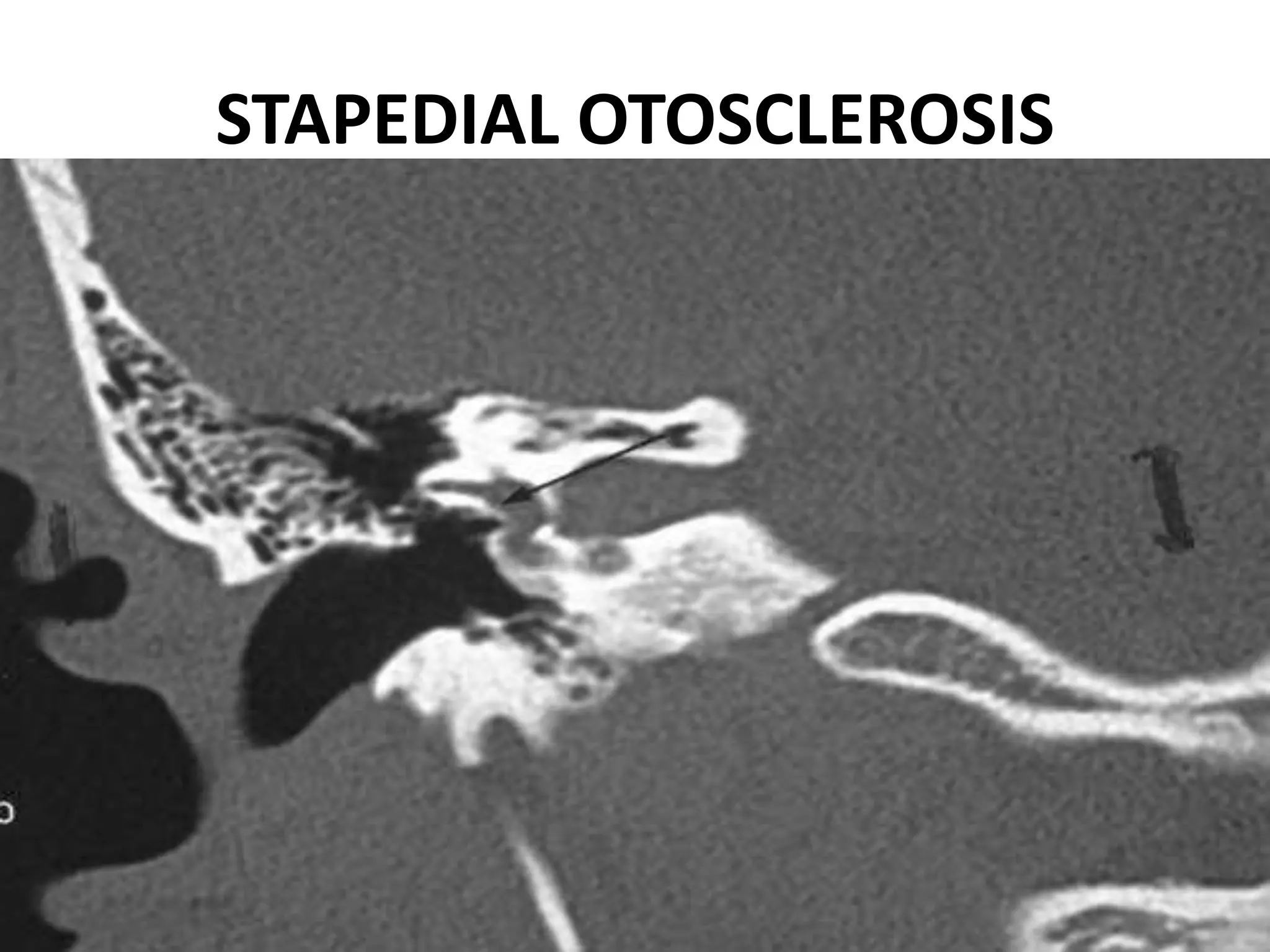 Otosclersis and stapes surgical management | PPT