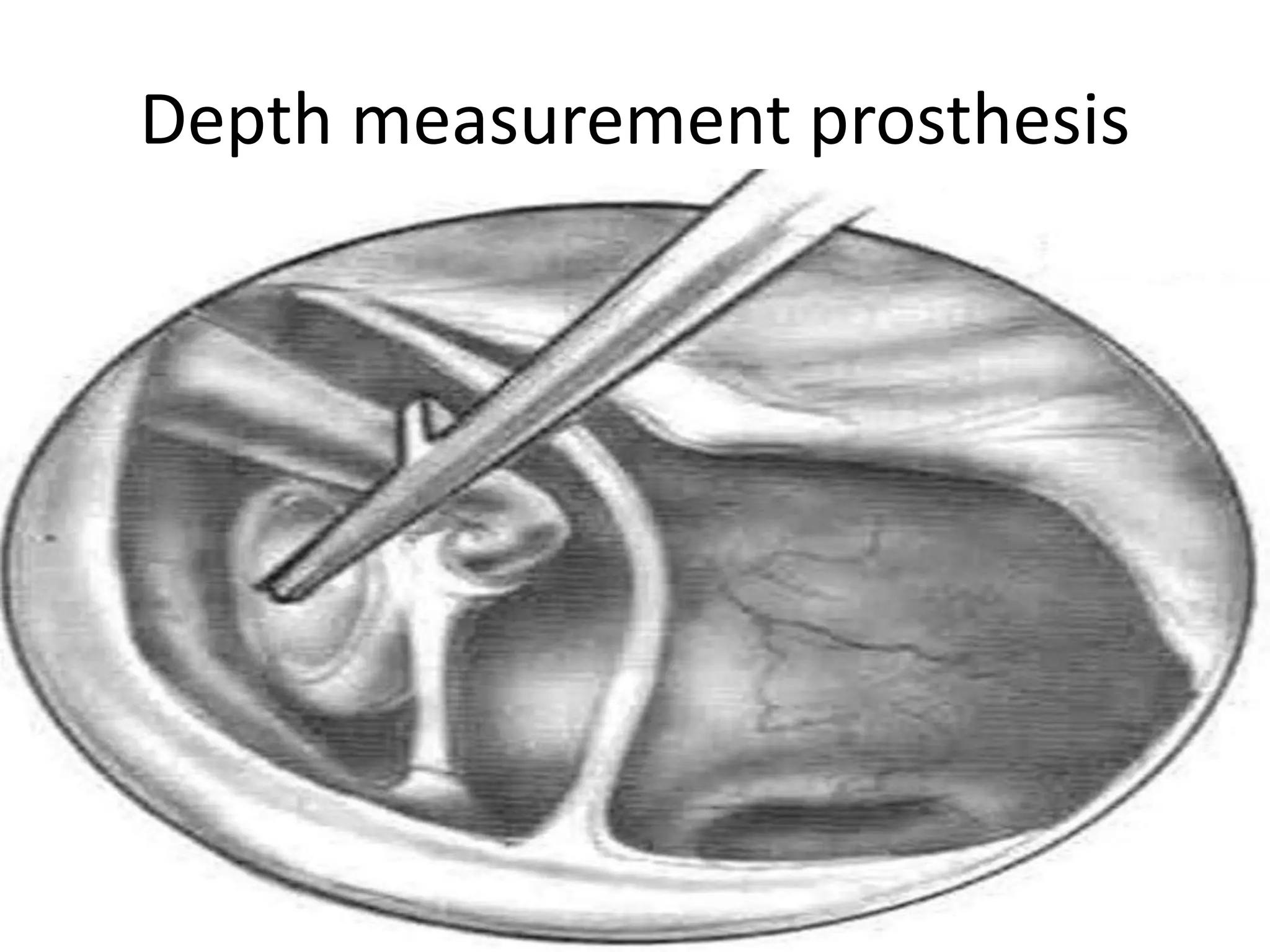 Otosclersis and stapes surgical management | PPT
