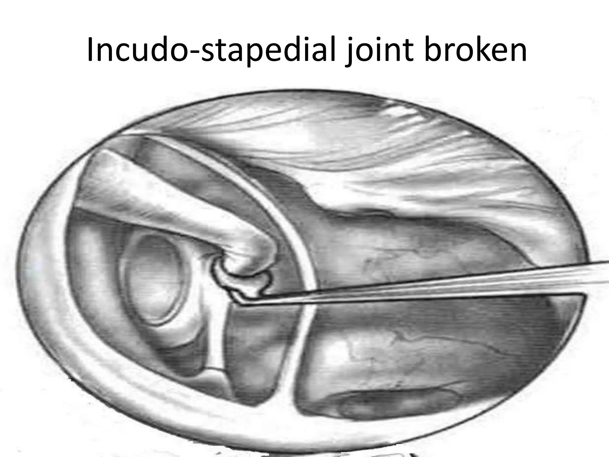 Otosclersis and stapes surgical management | PPT