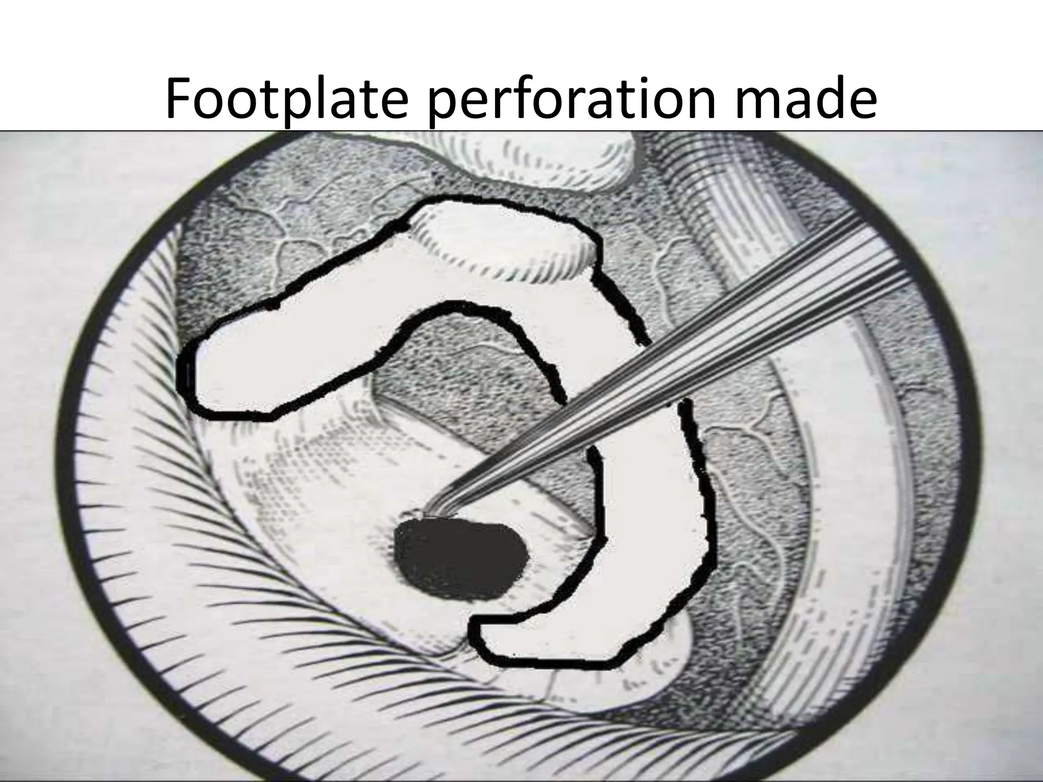 Otosclersis and stapes surgical management | PPT