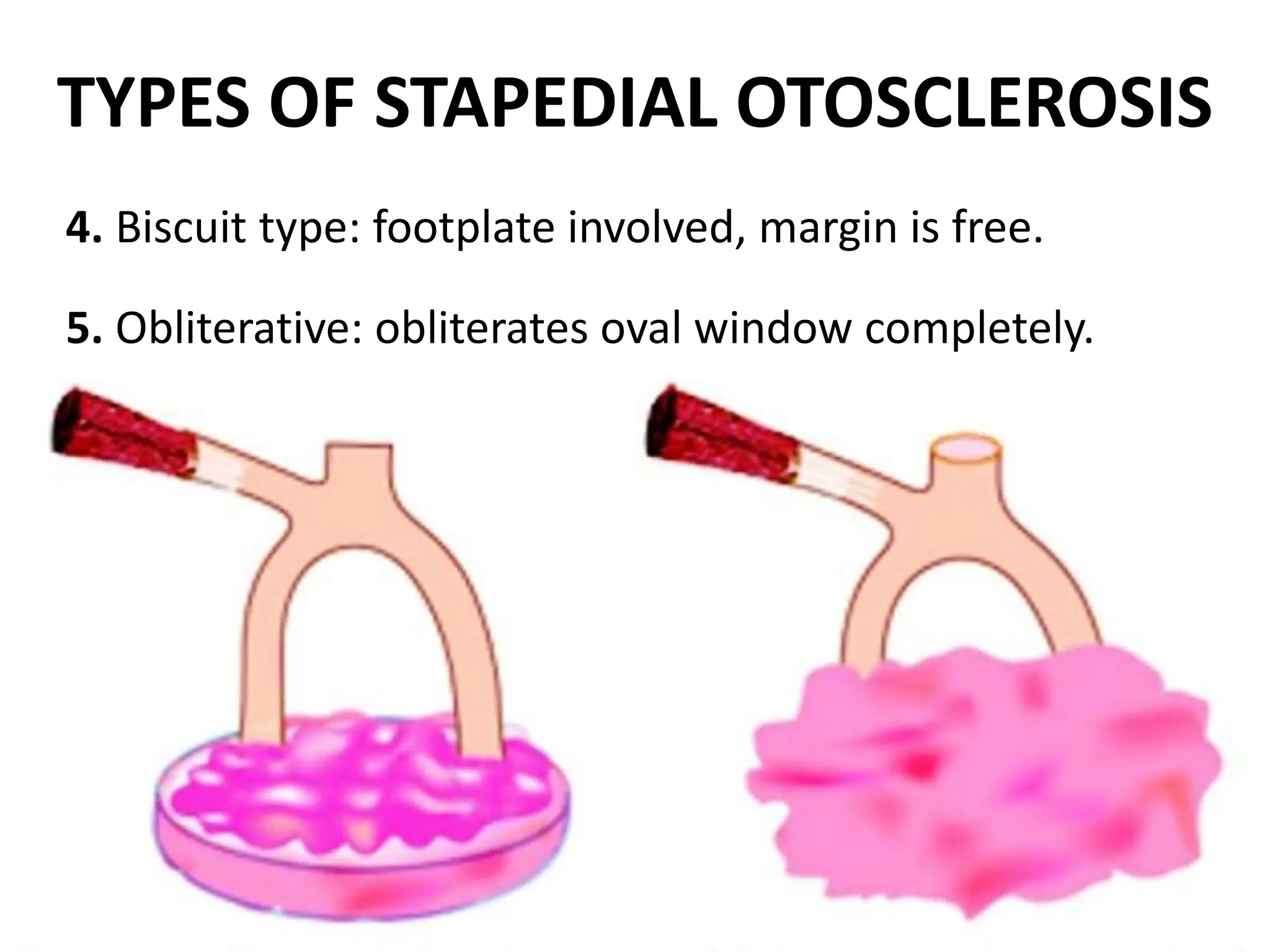 Otosclersis and stapes surgical management | PPT