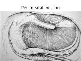 Otosclersis and stapes surgical management | PPTX