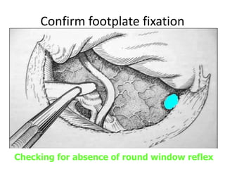 Otosclersis and stapes surgical management | PPTX