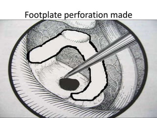 Otosclersis and stapes surgical management | PPTX