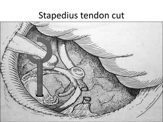 Otosclersis and stapes surgical management | PPTX