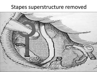 Otosclersis and stapes surgical management | PPTX