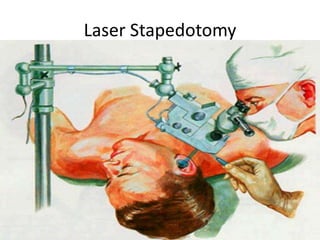 Otosclersis and stapes surgical management | PPTX
