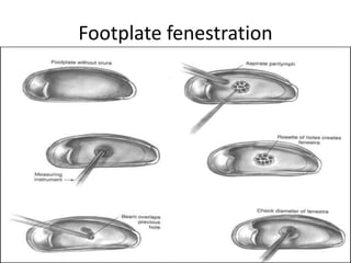 Otosclersis and stapes surgical management | PPTX