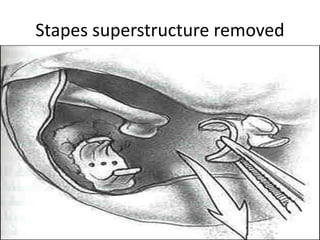 Otosclersis and stapes surgical management | PPTX
