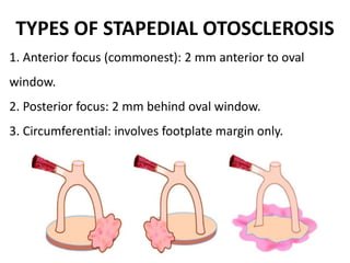 Otosclersis and stapes surgical management | PPTX